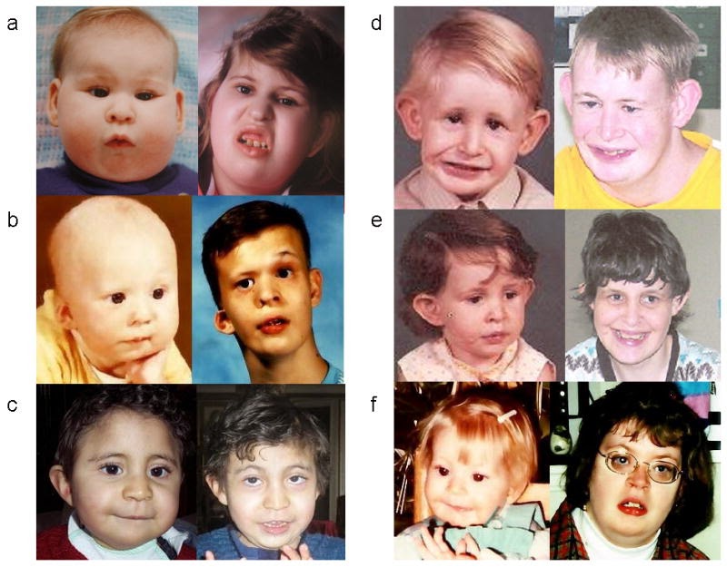 Sindrome de trisomia - bucksjza